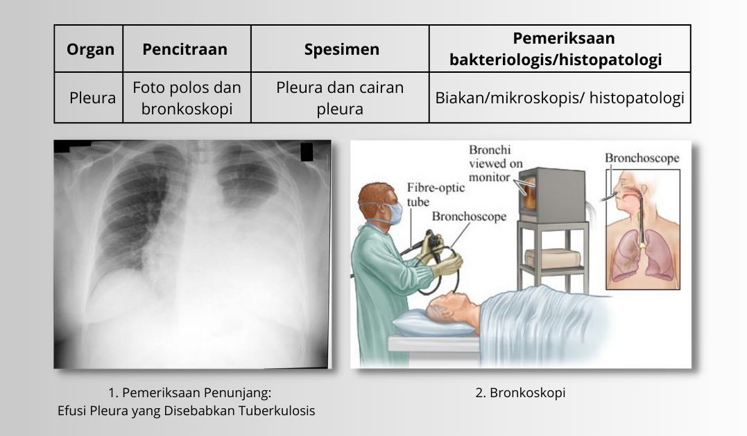 Tuberkulosis (TBC) Pleura | Yayasan KNCV Indonesia